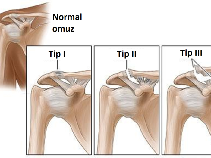 Akromiyoklaviküler Eklem Neresidir? Hastalıkları - Doktor Fizik